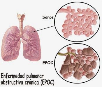 Enfermedad Pulmonar Obstructiva Crónica (EPOC) - Vivir mejor